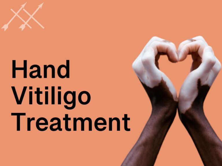 Hand vitiligo treatment - Machu Tattoo Studio